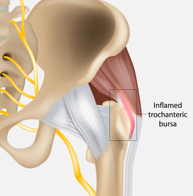 Hip Bursitis Treatment in Singapore