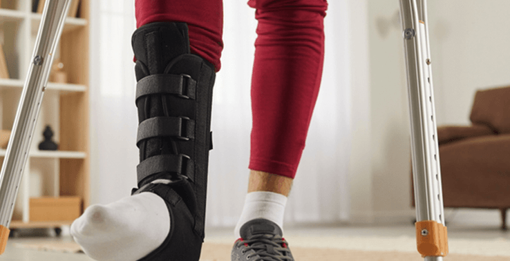 Leg Fractures | Diagnosing & Treating a Broken Leg - IOC Ortho